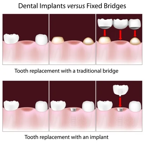 Replacing Missing Teeth Bethesda MD | Replace Tooth Near Rockville